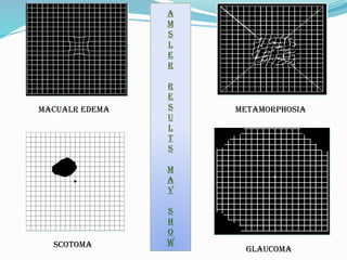 AMSLER GRID amsler Grid amsler grid.pptx