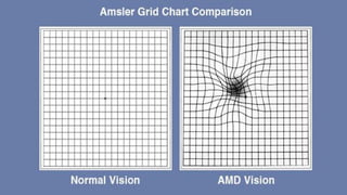 Amsler Grid Test | PDF