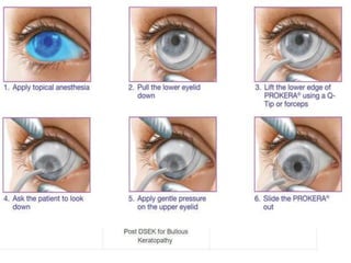 Amniotic membrane transplantation | PPTX