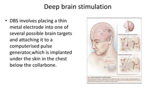 Deep brain stimulation | PPTX