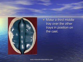 A multiple tray impression technique for implant retained orbital pro ...