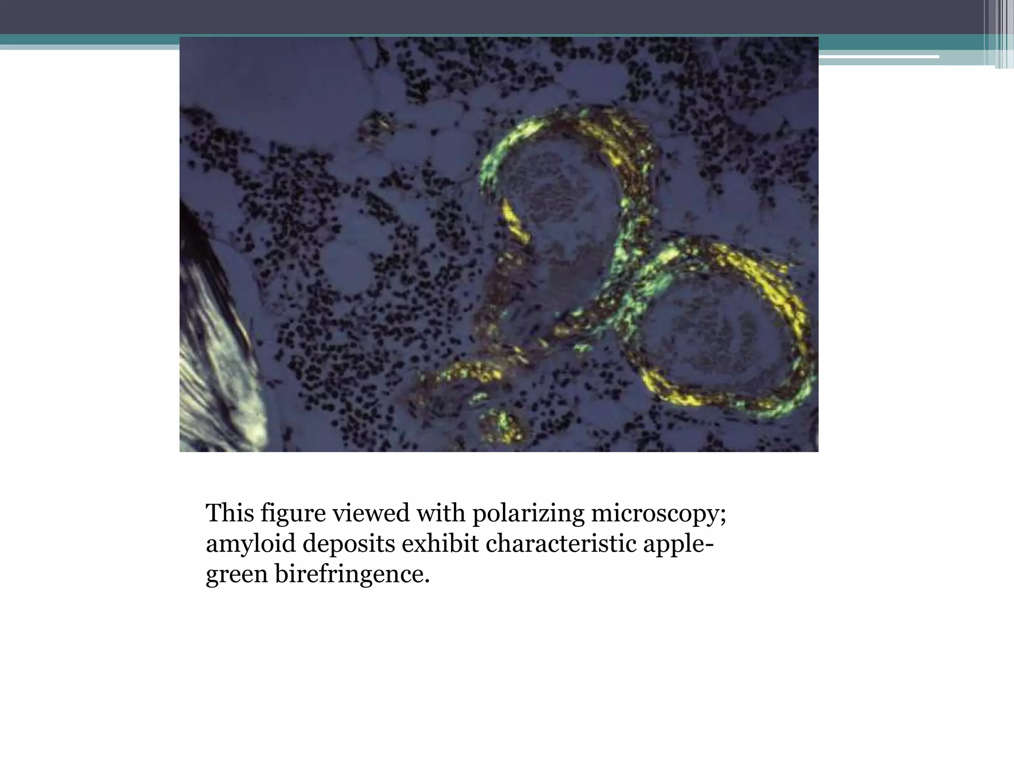 Amyloid | PPTX