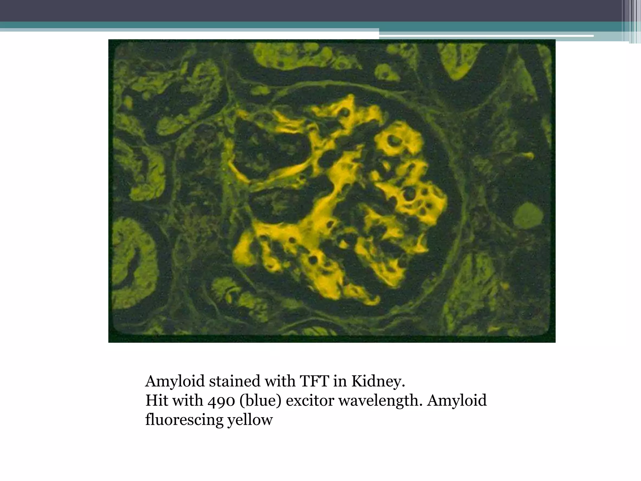 Amyloid | PPTX