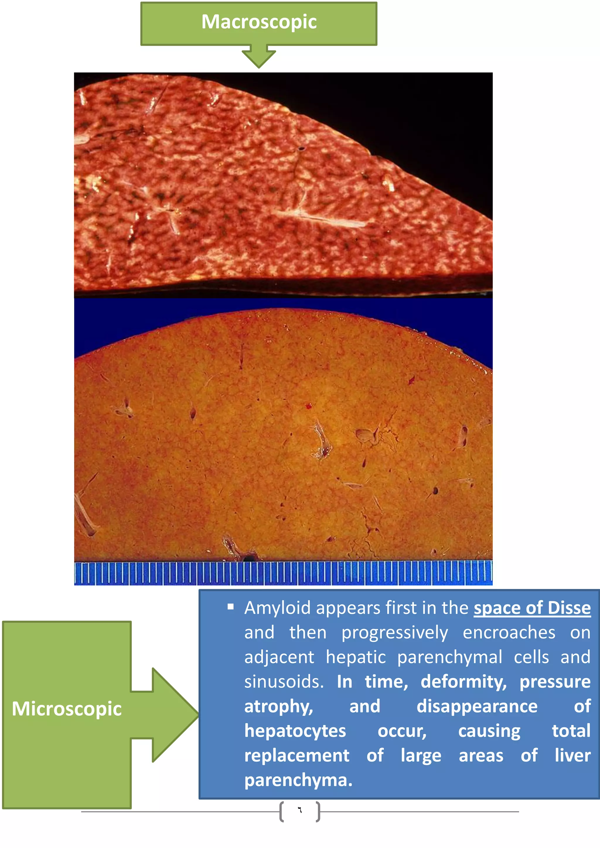 Amyloidosis | PDF
