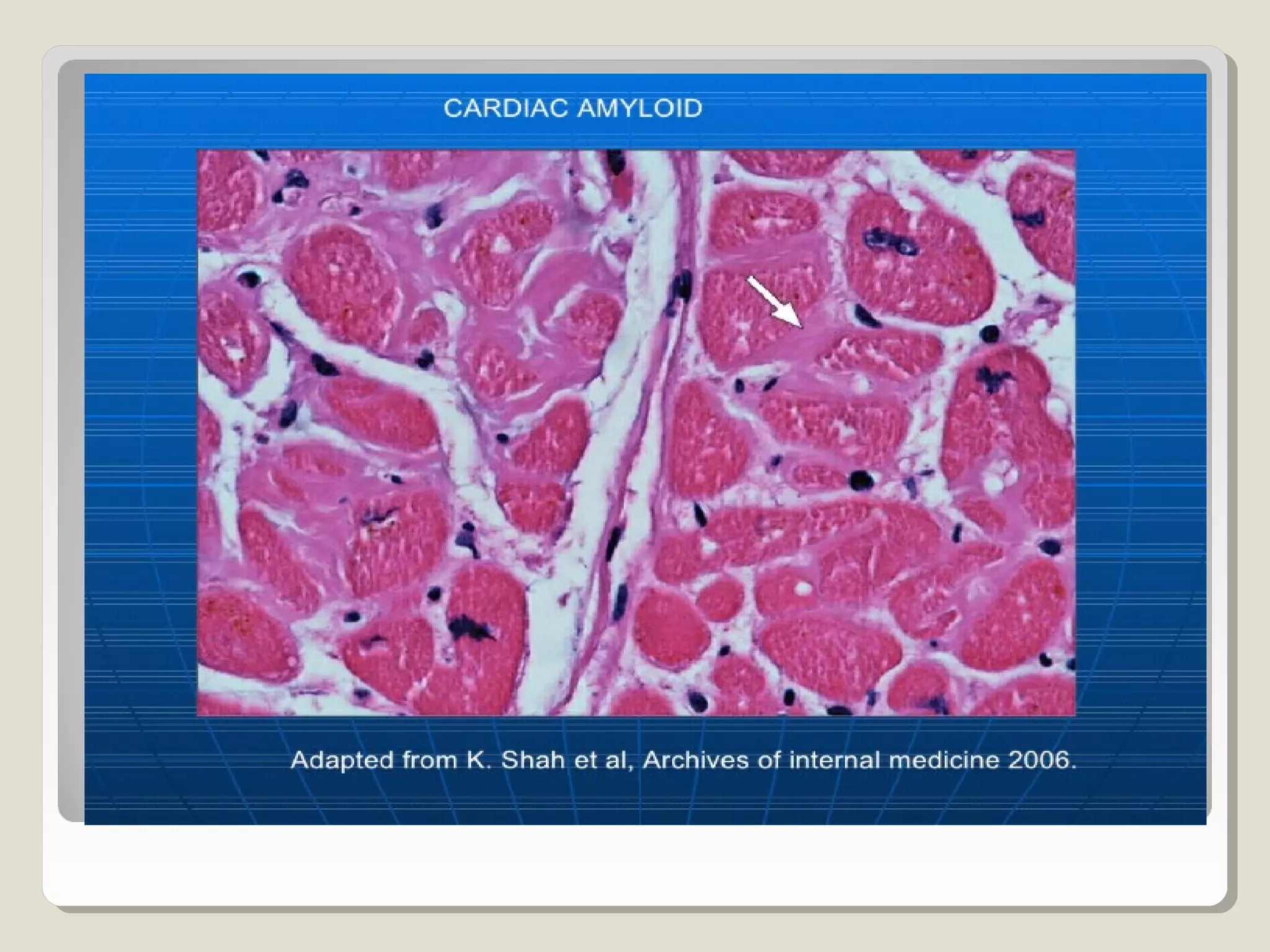 Amyloidosis | PPT