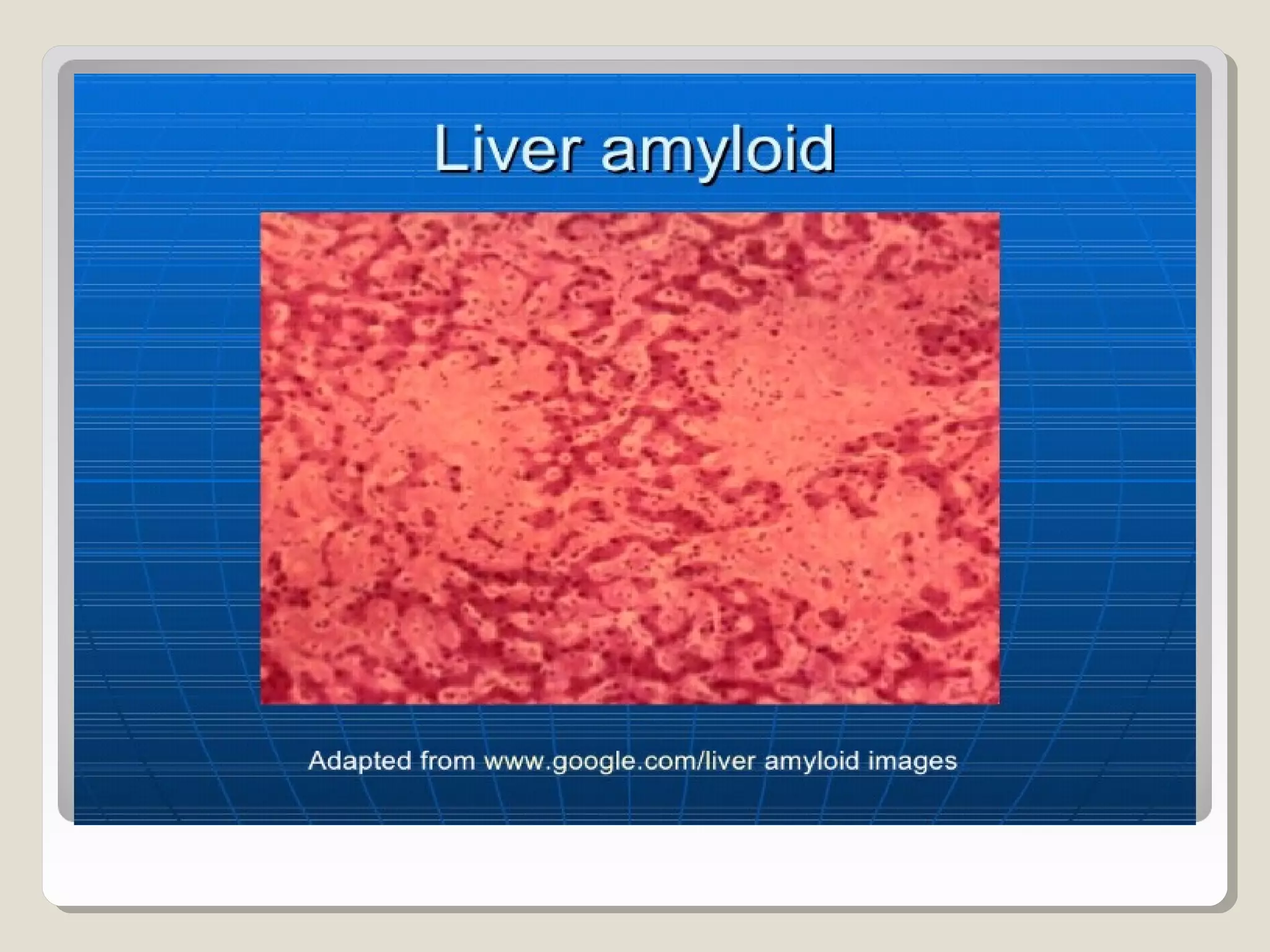 Amyloidosis | PPT