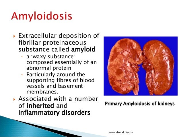 Amyloidosis