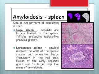 AMYLOIDOSIS | PPTX