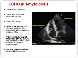 Cardiac Amyloidosis - Dr. Akif | PPT