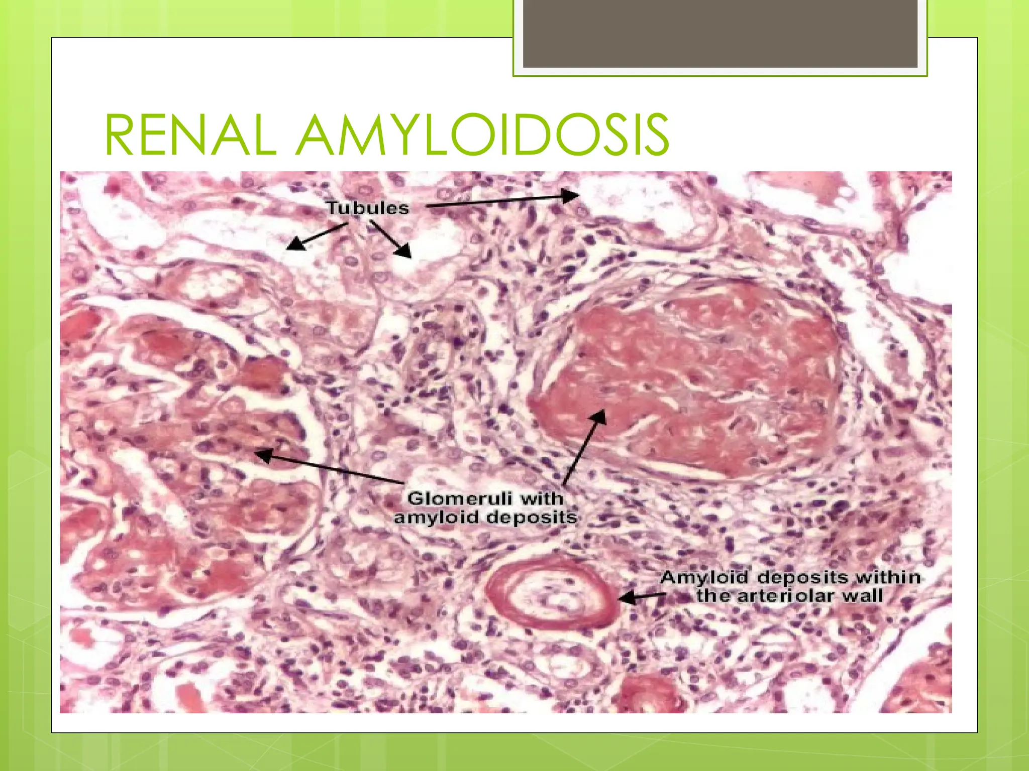 AMYLOIDOSIS pathology pptx ssr medical college | PPTX