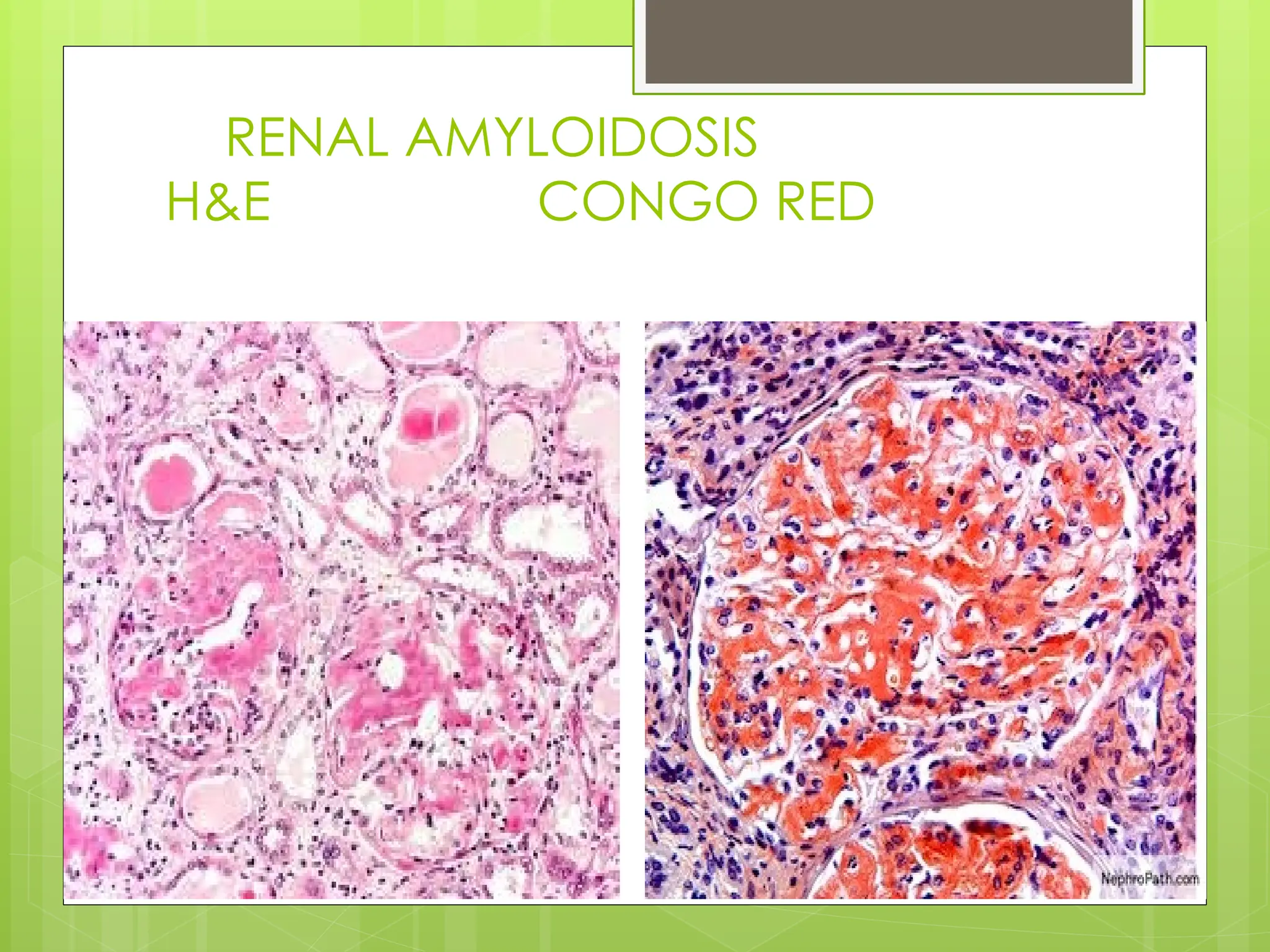 AMYLOIDOSIS pathology pptx ssr medical college | PPTX