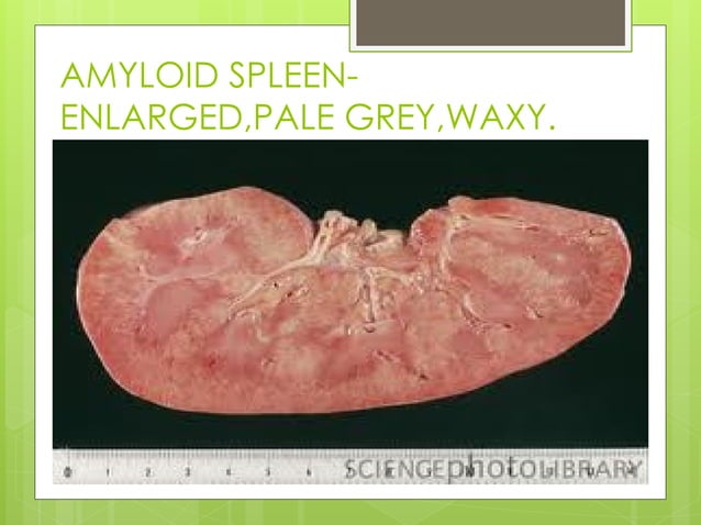 AMYLOIDOSIS pathology pptx ssr medical college | PPT