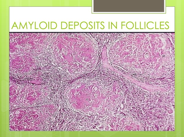 AMYLOIDOSIS pathology pptx ssr medical college | PPT