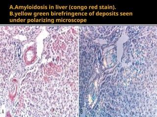 AMYLOIDOSIS diagnosis in laboratory.pptx