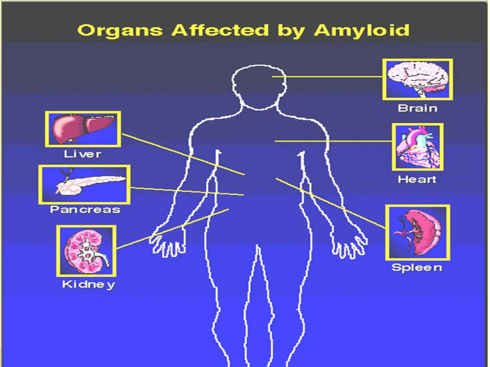 Amyloidosis ppt | PPT