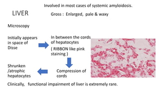 Amyloidosis 3 | PDF