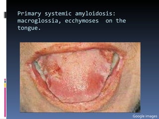 Macroglossia Amyloidosis