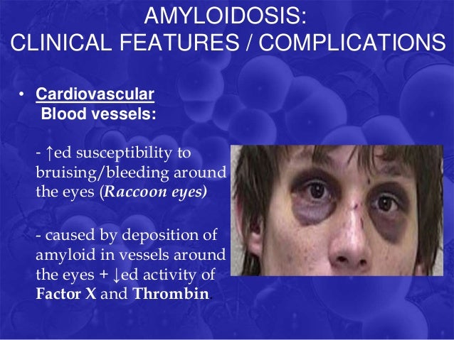 Amyloidosis