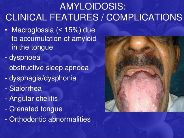 Amyloidosis