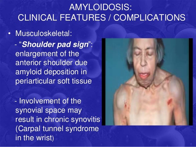 Shoulder Pad Sign Amyloidosis