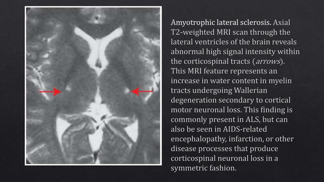 Amyotrophic Lateral Sclerosis (ALS) | PPT