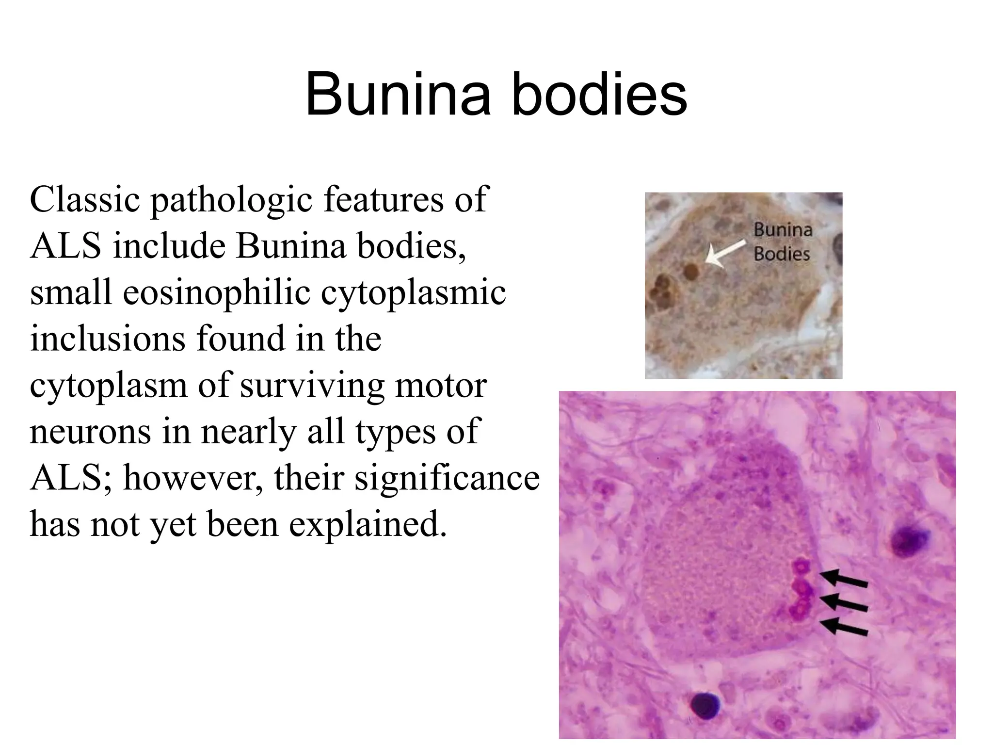 Amyotrophic Lateral Sclerosis | PPTX