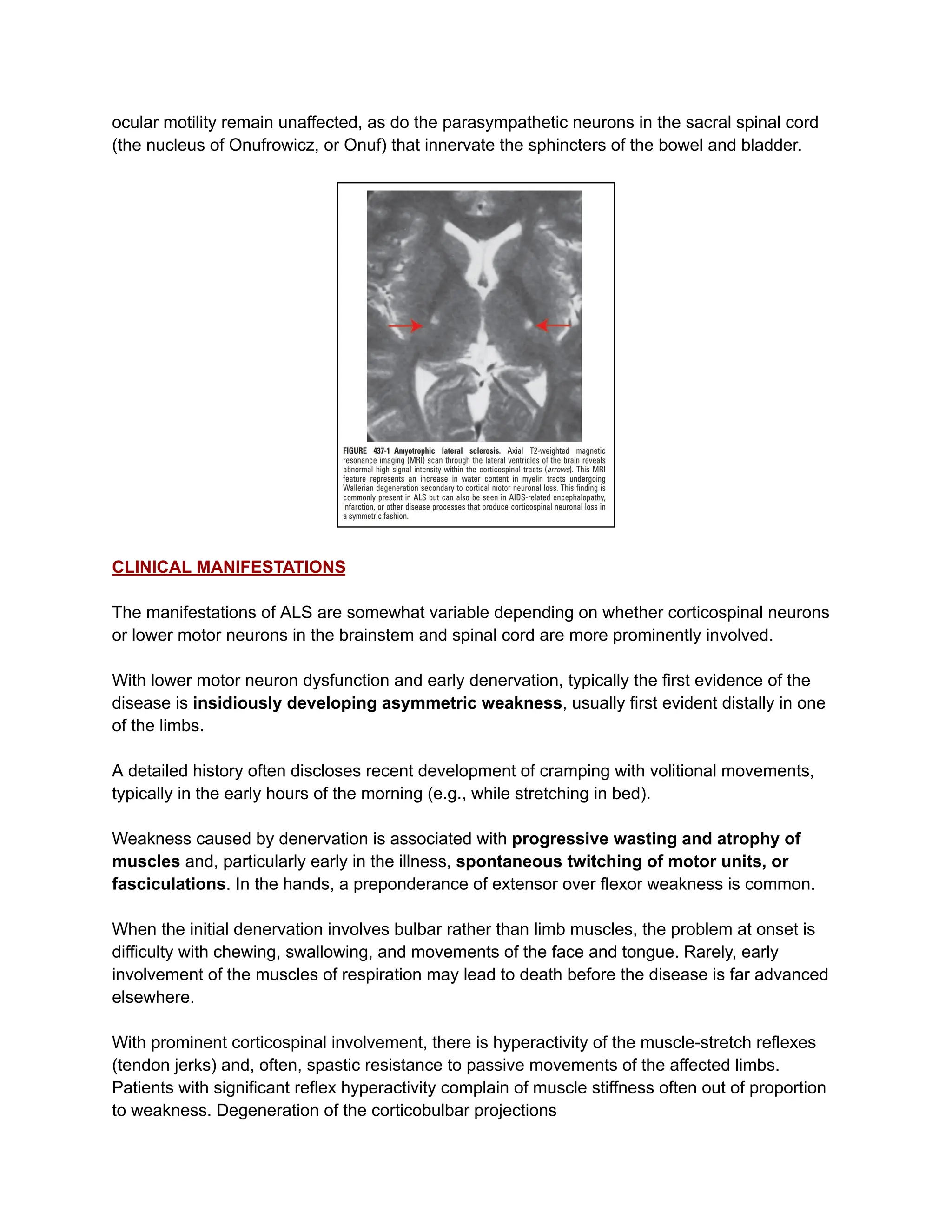 Amyotrophic Lateral Sclerosis ( Important Points ).pdf
