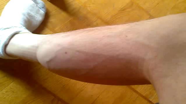 Amyotrophic lateral sclerosis (als) | PPTX | Dental Health | Diseases and Conditions