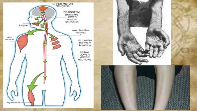 Amyotrophic lateral sclerosis (als)