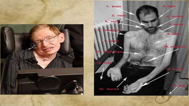 Amyotrophic Lateral Sclerosis Als