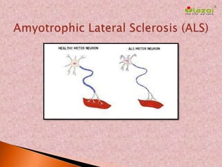 Amyotrophic lateral sclerosis (als) | PPTX