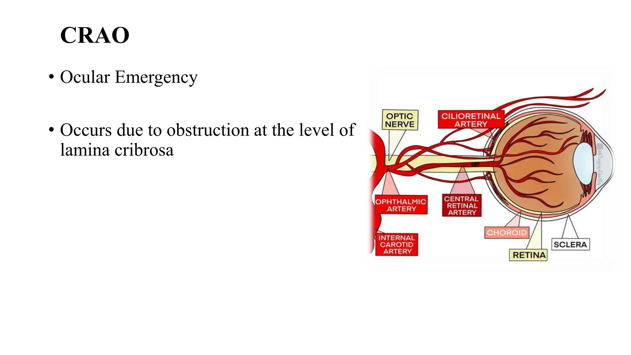 RETINAL ARTERY OCCLUSIONS CRAO BRAO CLRAO | PPTX