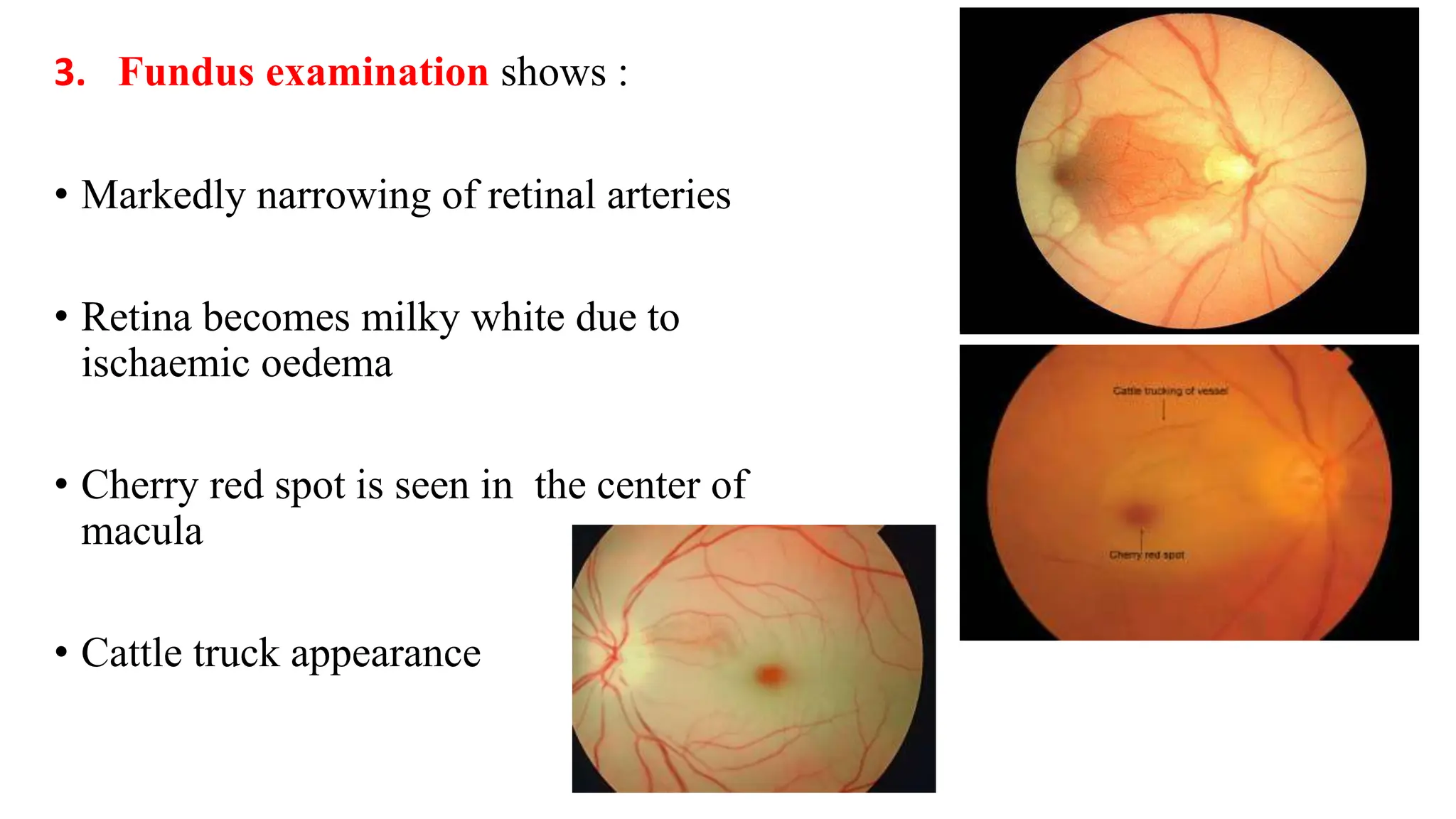 RETINAL ARTERY OCCLUSIONS CRAO BRAO CLRAO | PPTX