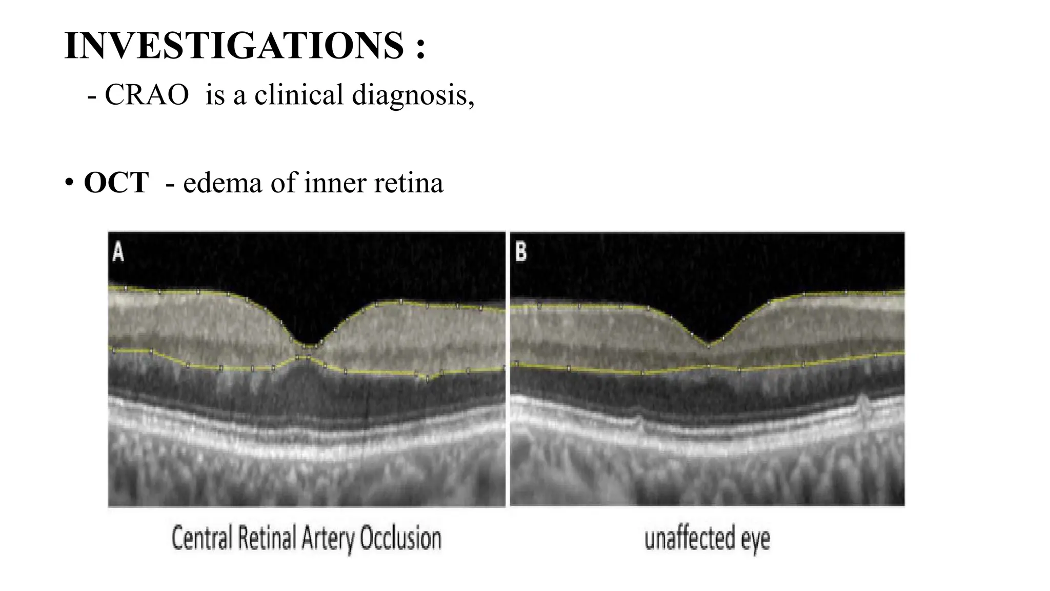 RETINAL ARTERY OCCLUSIONS CRAO BRAO CLRAO | PPTX