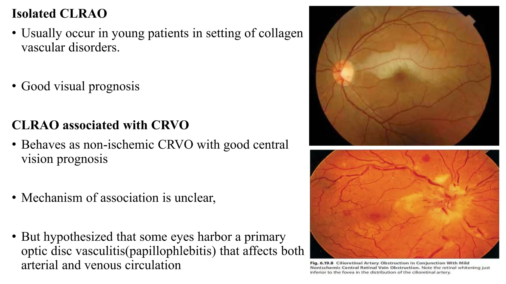 RETINAL ARTERY OCCLUSIONS CRAO BRAO CLRAO | PPTX