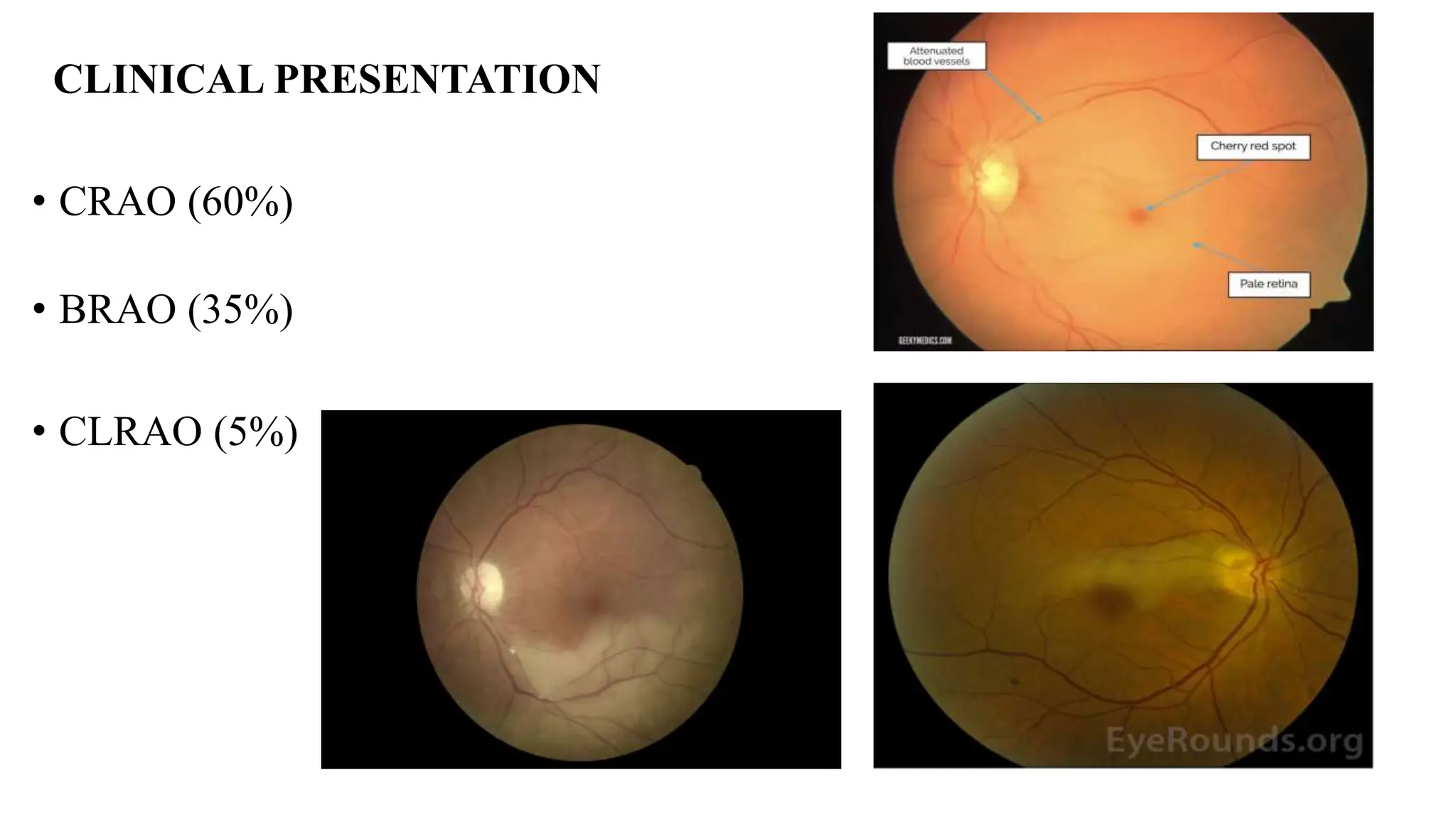 RETINAL ARTERY OCCLUSIONS CRAO BRAO CLRAO | PPTX