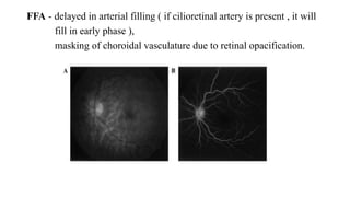 RETINAL ARTERY OCCLUSIONS CRAO BRAO CLRAO | PPTX