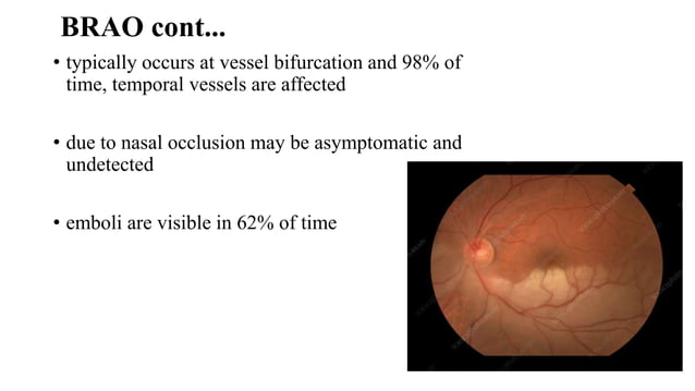 RETINAL ARTERY OCCLUSIONS CRAO BRAO CLRAO | PPTX | Eye and Vision ...