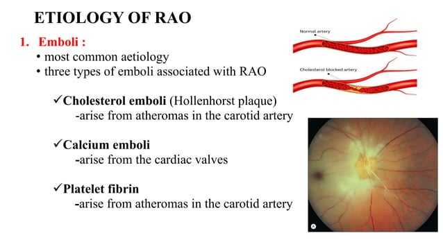 RETINAL ARTERY OCCLUSIONS CRAO BRAO CLRAO | PPTX | Eye and Vision ...