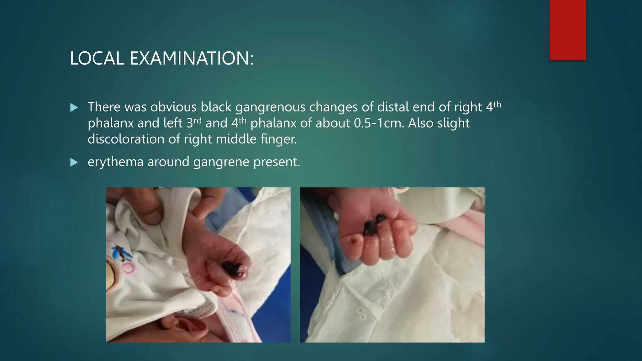 Protein C deficiency in Neonate - rare presentation | PPTX