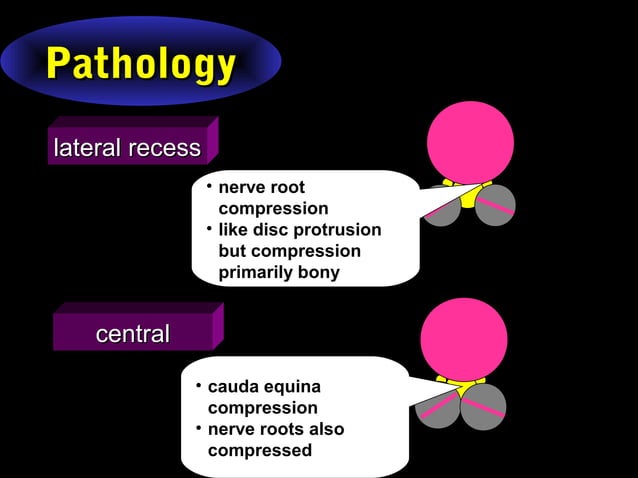 Common conditions of the lumbar spine | PPT | Physical Therapy | Wellness