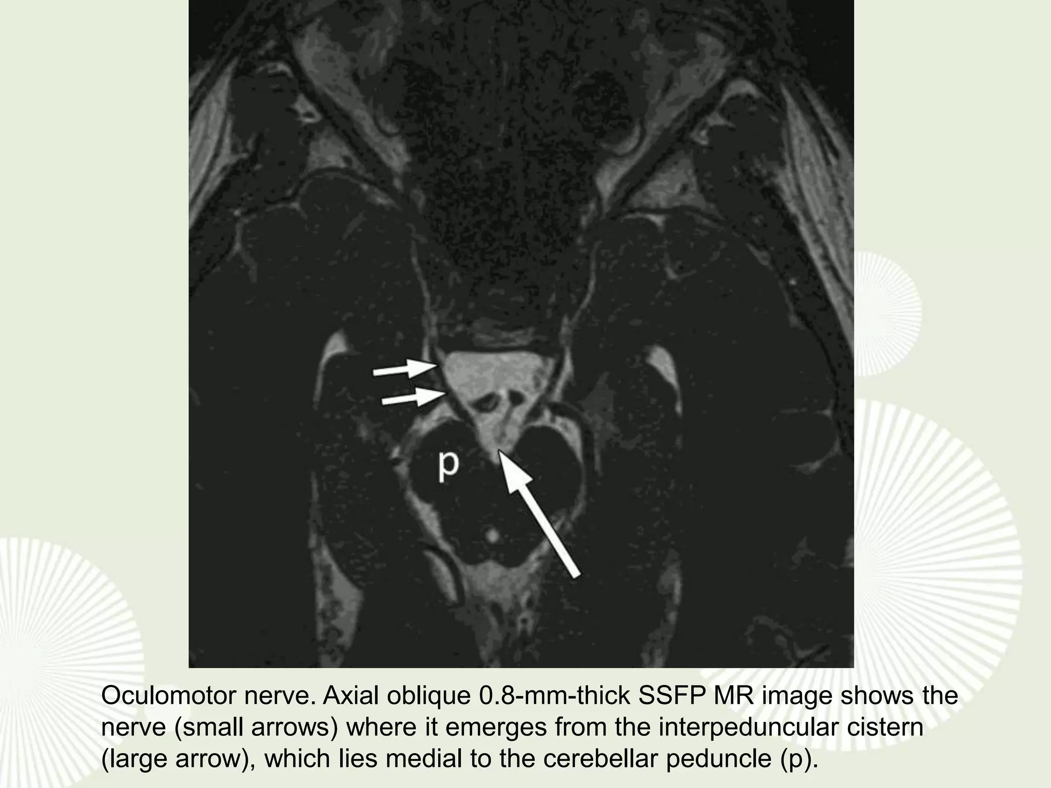 Anatomy of 3rd cranial nerve | PPTX