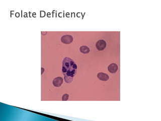 Folate Deficiency Smear