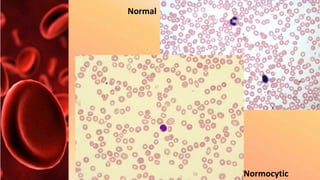 Anaemia classification final last new | PPTX
