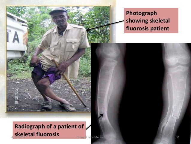 Anaemia, Fluorosis, IDD, Lathyrism