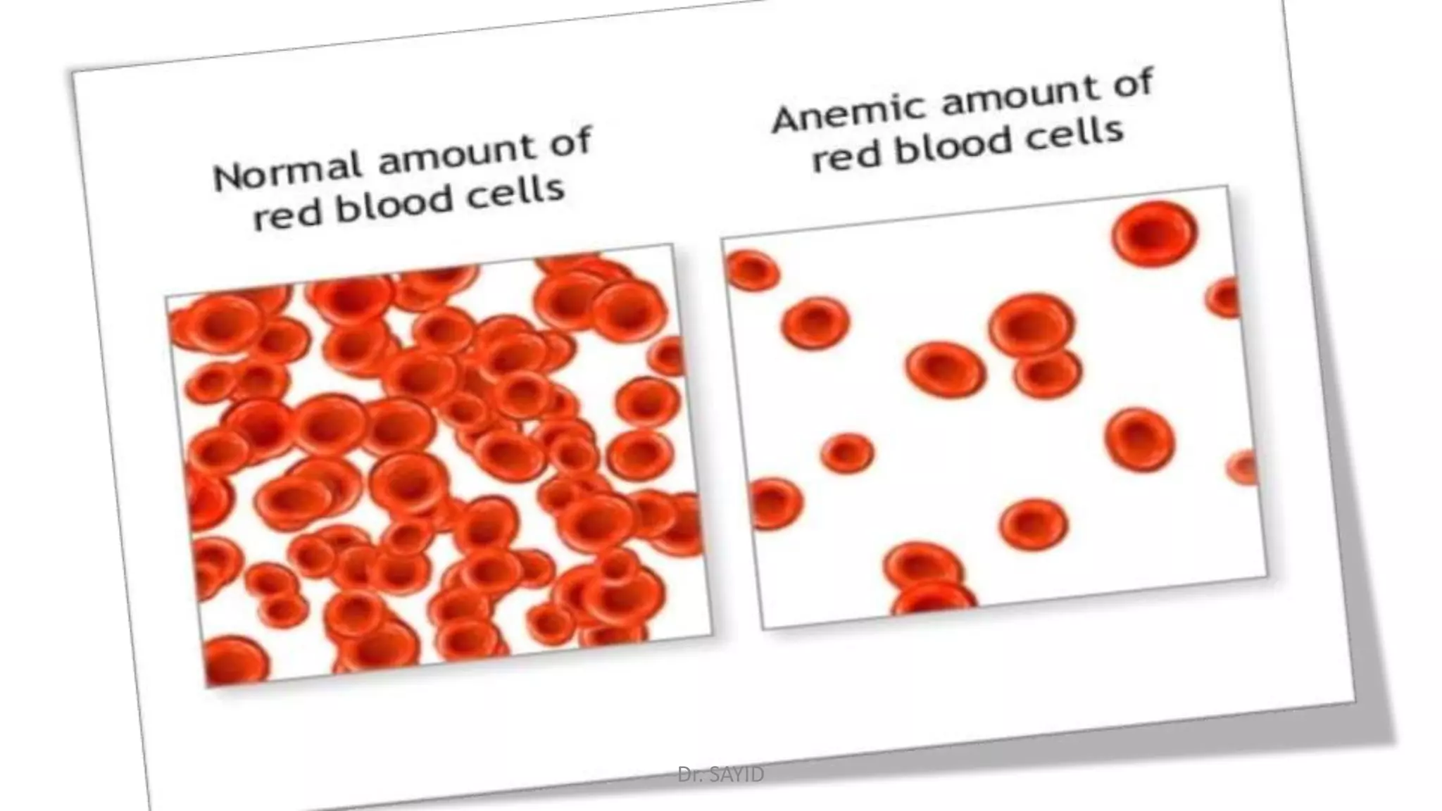 Anemia,classification of anaemia, Hb, RBC indicie | PPTX