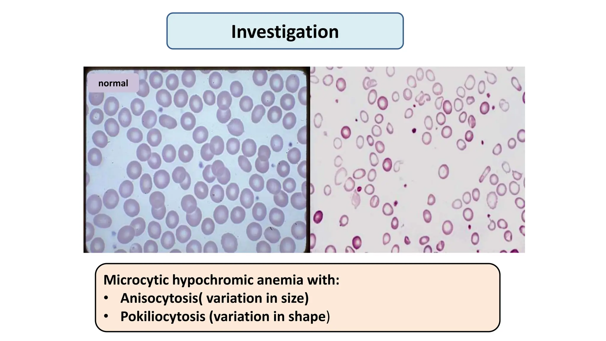 ANAEMIAS CAUSES PREVENTION AND MANAGEMENT.pptx
