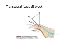 ANAESTHESIA ,LOCAL ANAESTHESIA AND ITS CLASSIFICATION | PPT