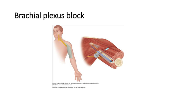 ANAESTHESIA ,LOCAL ANAESTHESIA AND ITS CLASSIFICATION | PPT