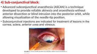 Ocular Anaesthesia by Sachin Mahatra.pptx